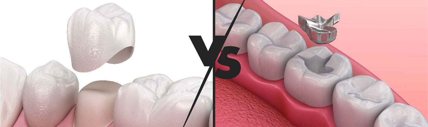 Dental Crowns vs Fillings Which is Best - Crown vs Filling